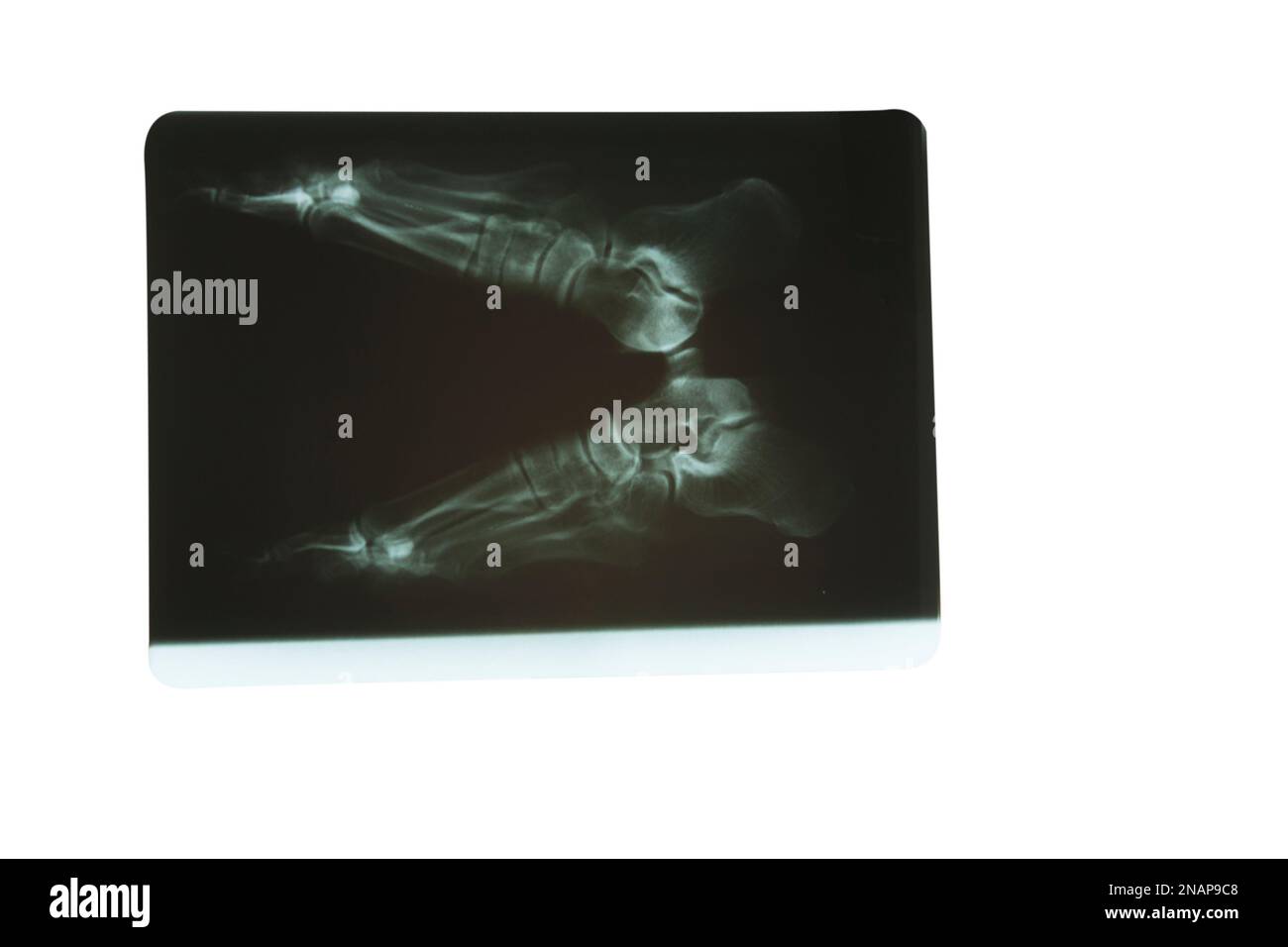 X-ray image of human foot shows metatarsal toes and ankle with bony structure Stock Photo - Alamy