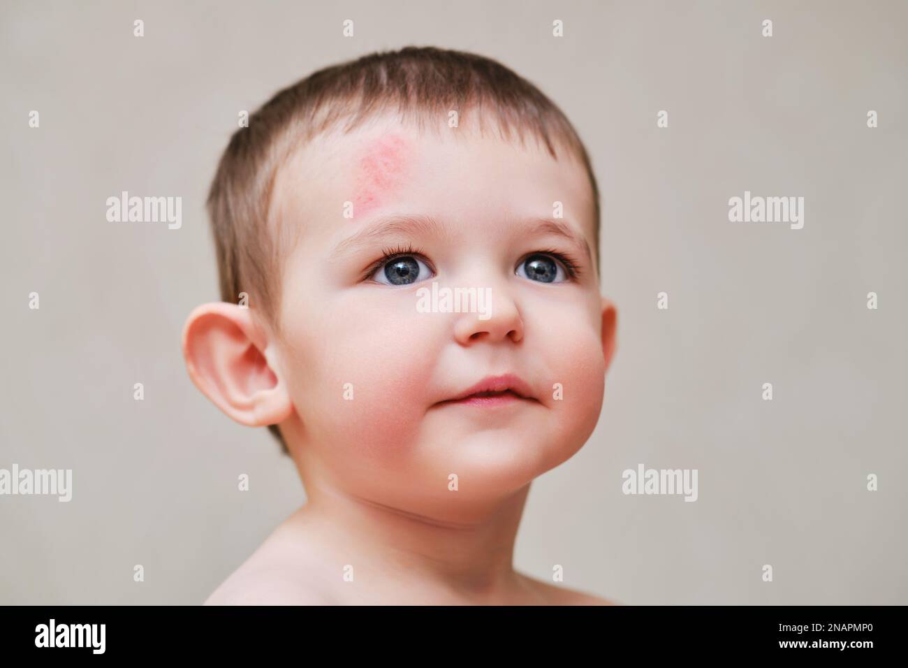 Toddler baby face with scratch on forehead. Portrait of a baby boy with ...