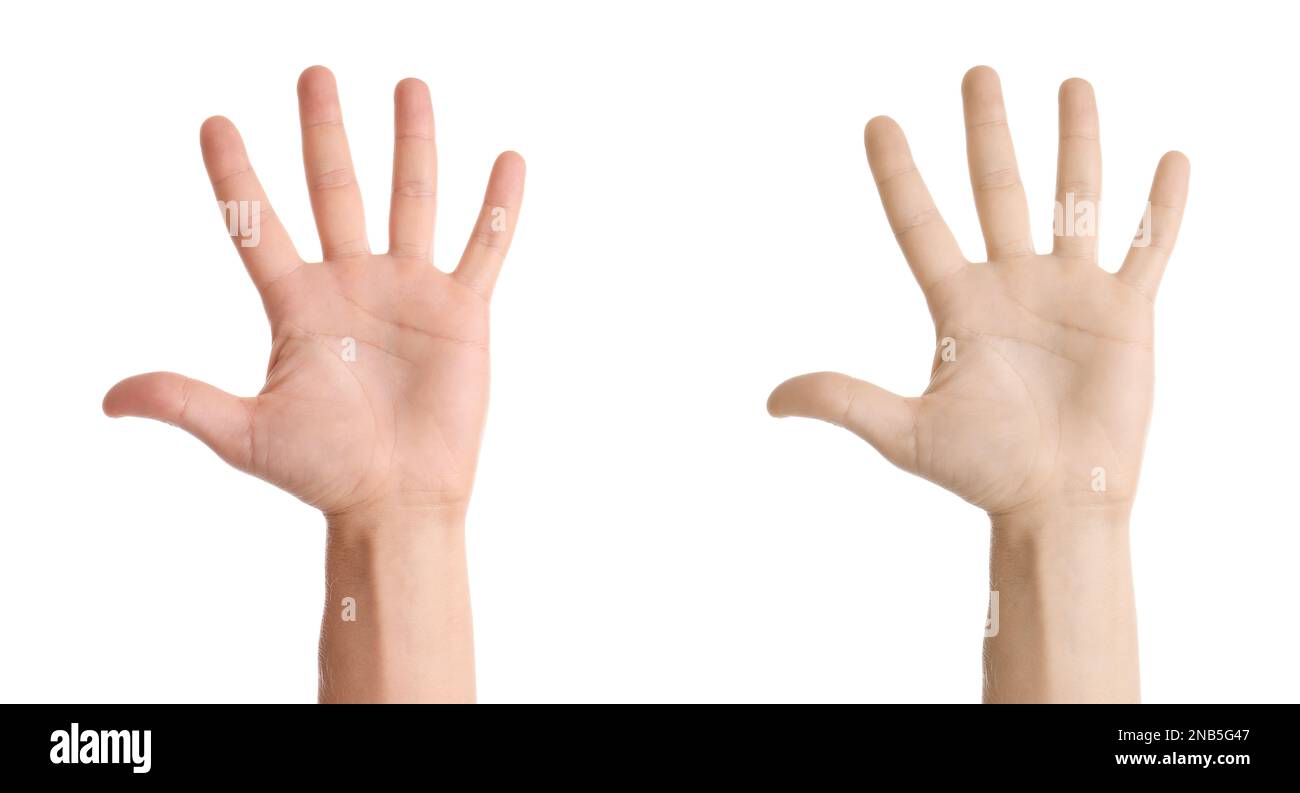 Healthy and sick men showing palms on white background, closeup. Anemia ...