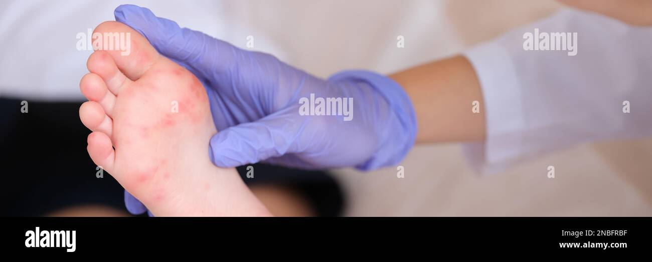 Rash with enterovirus infection of picornavirus family on feet of child ...