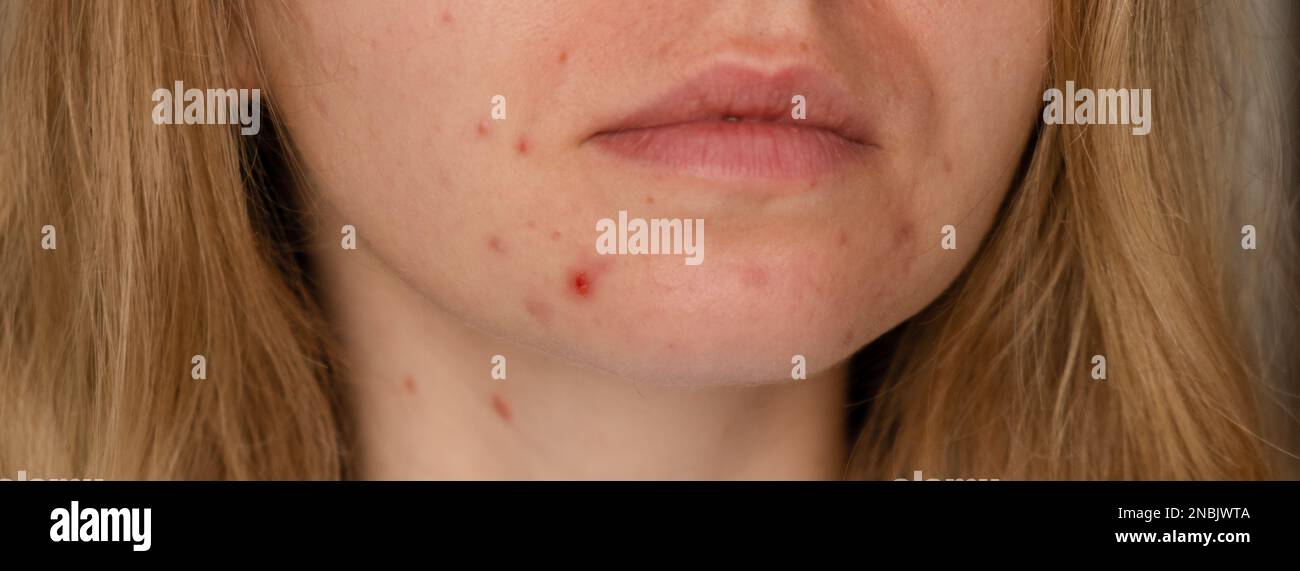 Unrecognizable woman showing her acne on face. Close-up acne on woman's ...