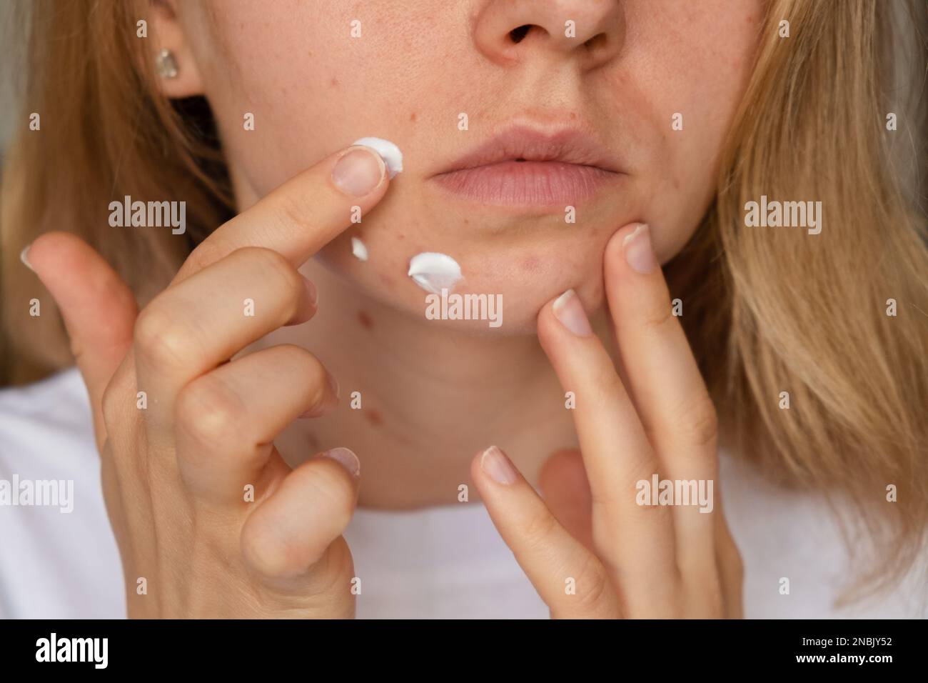 Unrecognizable woman applies makeup, cream serum cure for acne on face ...