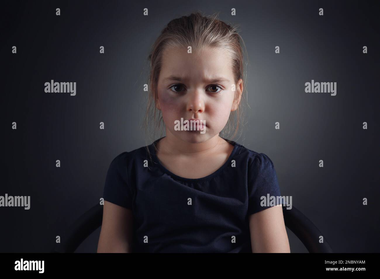 Little girl with bruises on face against dark background. Domestic ...