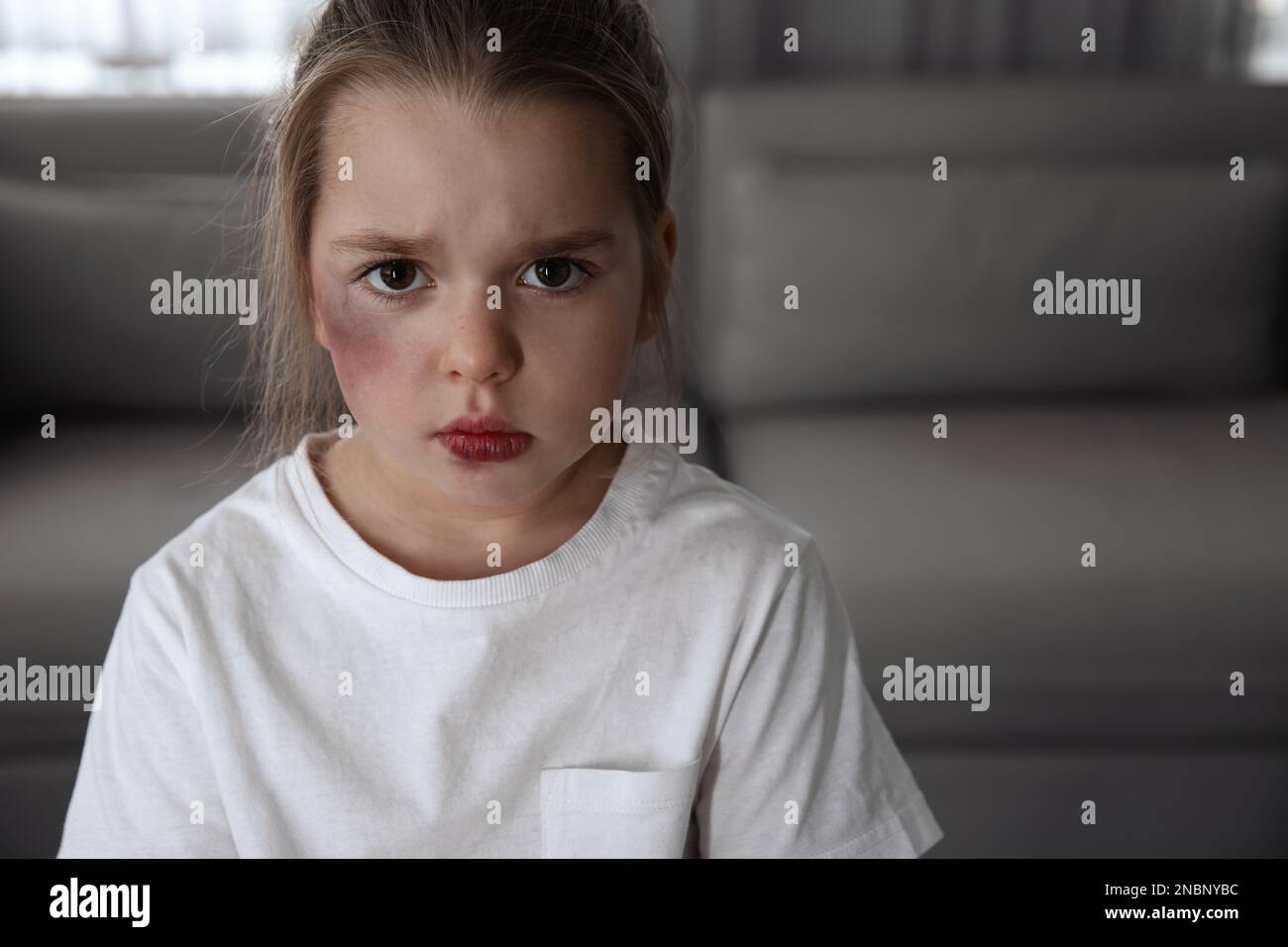 Little girl with bruises on face at home, space for text. Domestic ...