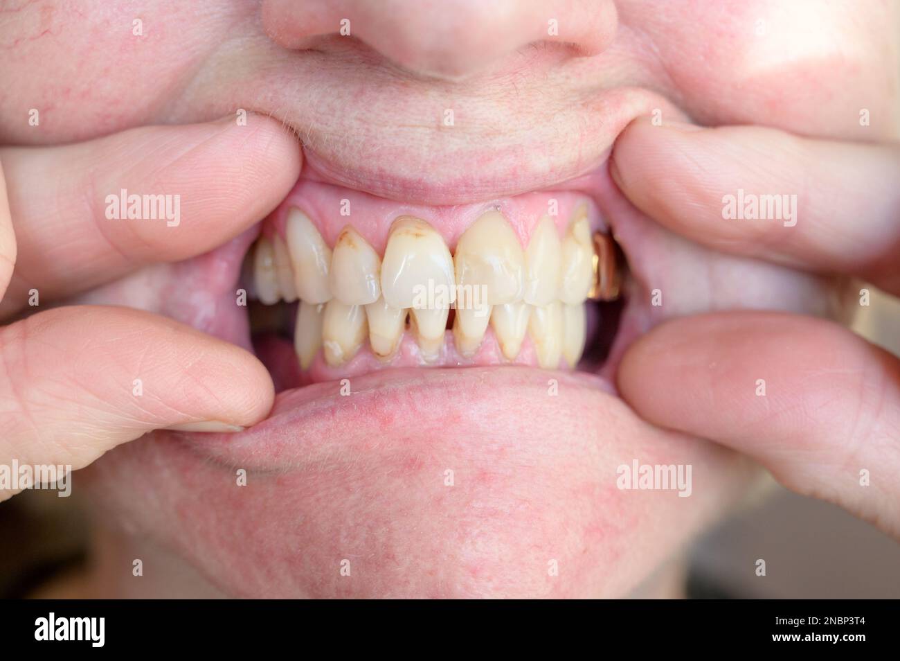 Close-up photo of natural looking teeth of a aged woman Stock Photo - Alamy