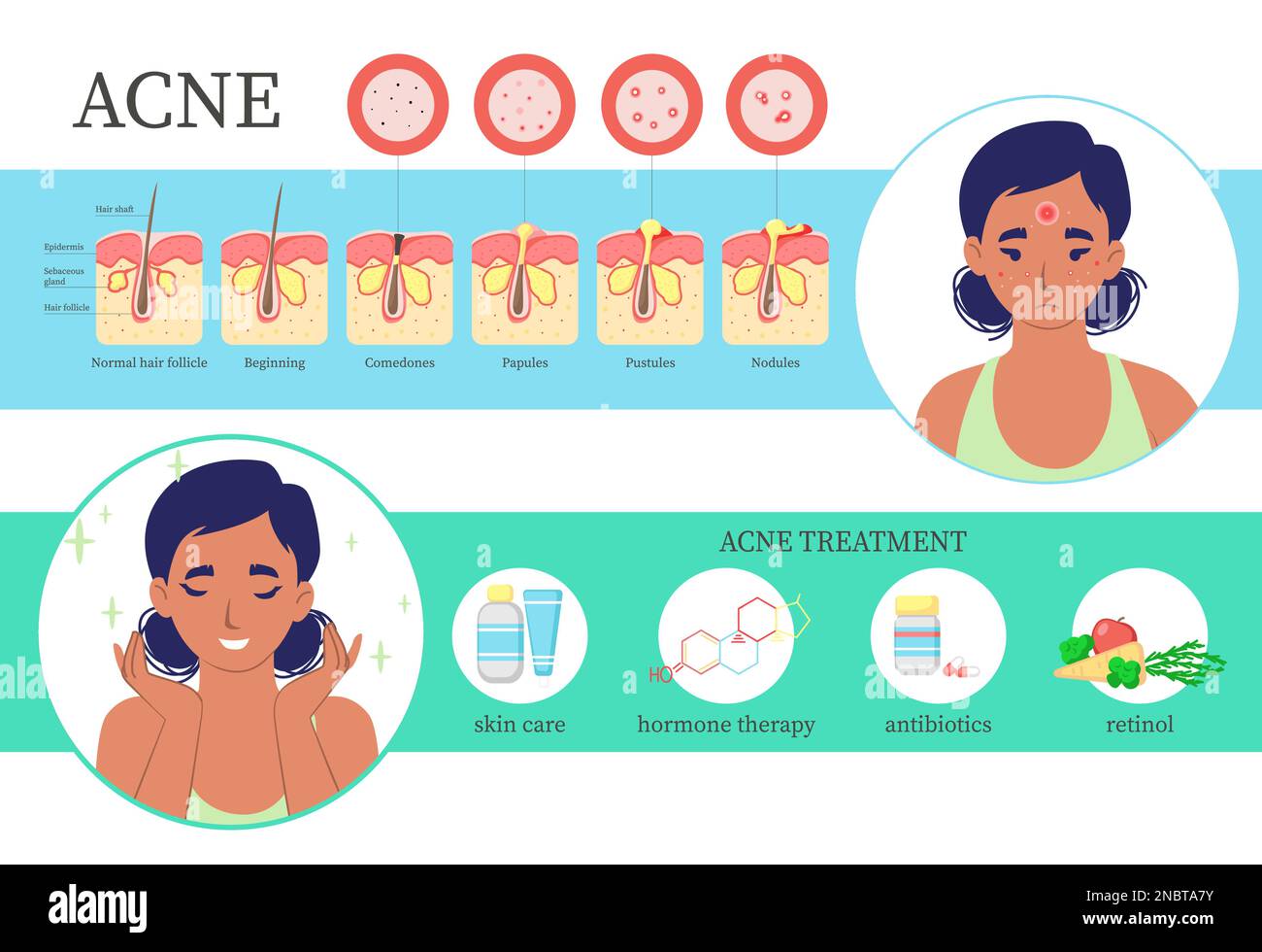 Acne flat vector face skin treatment infographic Stock Vector Image ...
