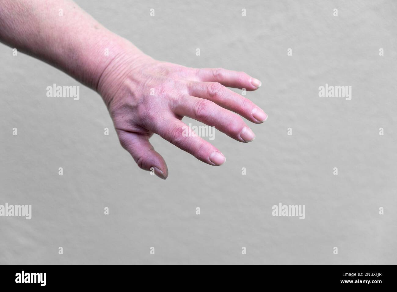 Hand Of Woman Deformed From Rheumatoid Arthritis Stock Photo - Alamy