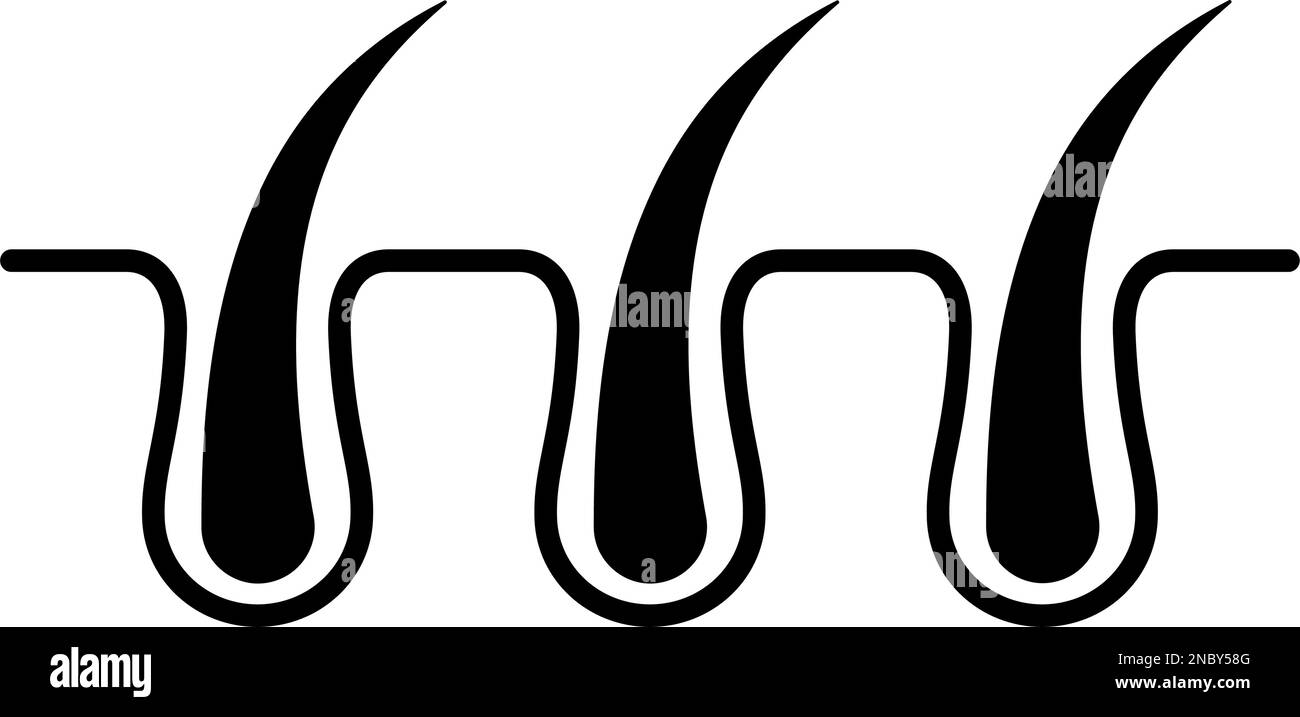 Cross-section of pore before hair removal, illustration of image of ...