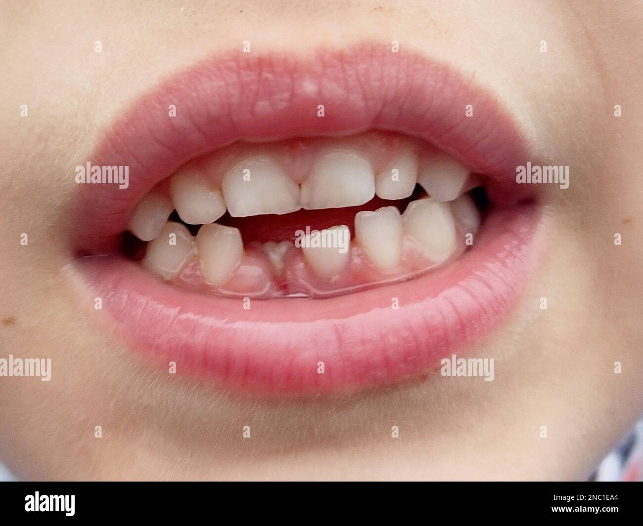 A 6-and-a-half-year-old boy lost his first milk tooth. Toothless boy ...