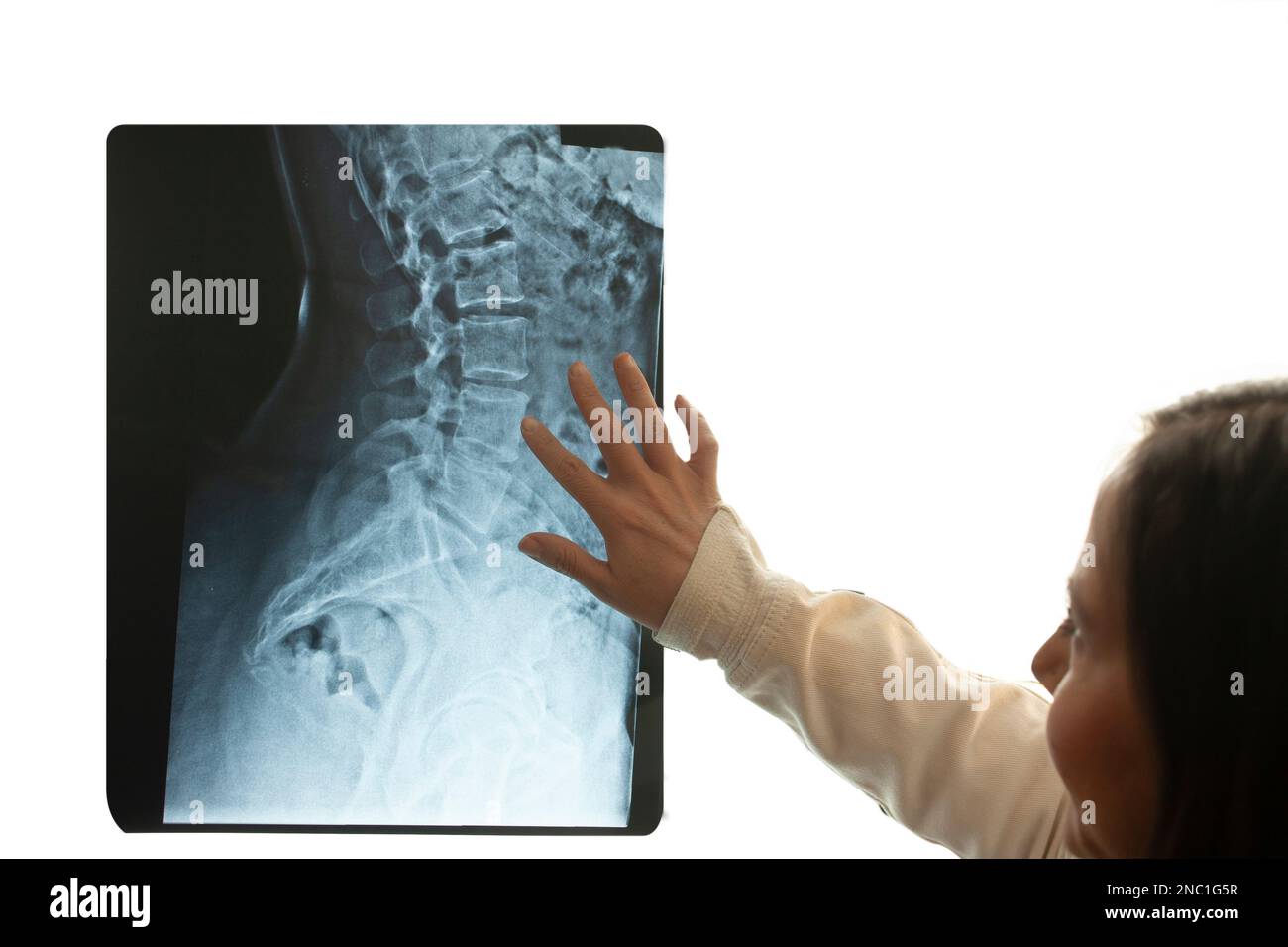 Doctor observing lumbar displacement in patient with congenital ...