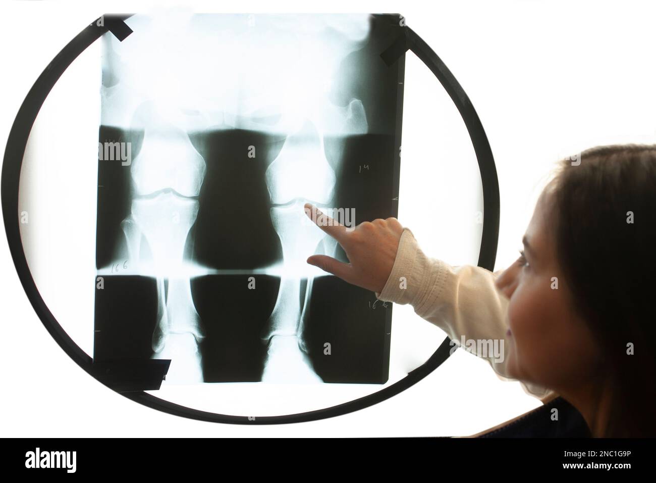 Doctor reviews radiographic study of patellar area reviewing patient's ...