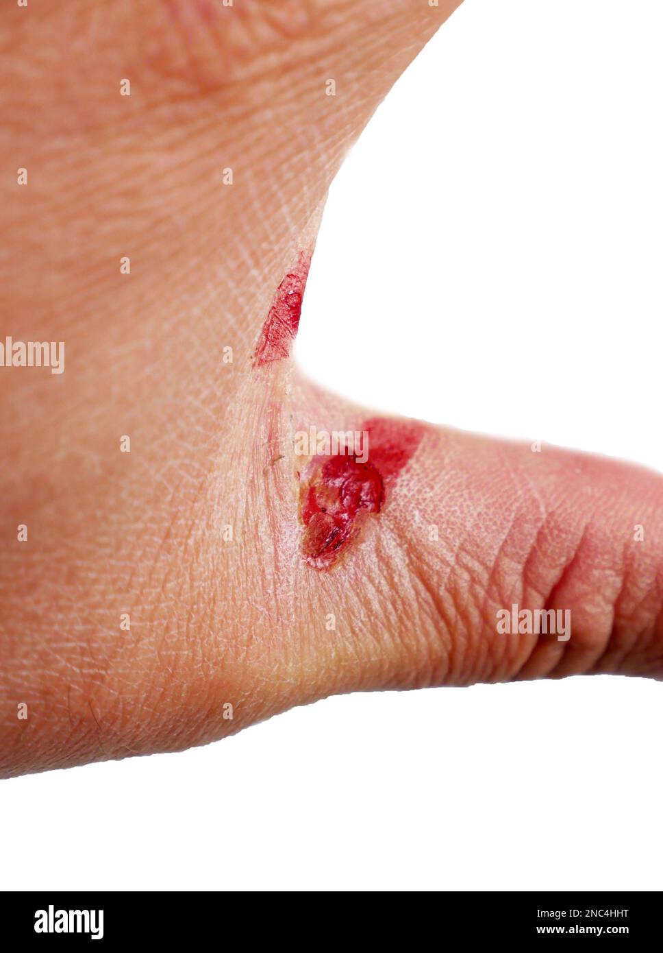 work accident-a human hand injured after a work accident, hand injuries ...