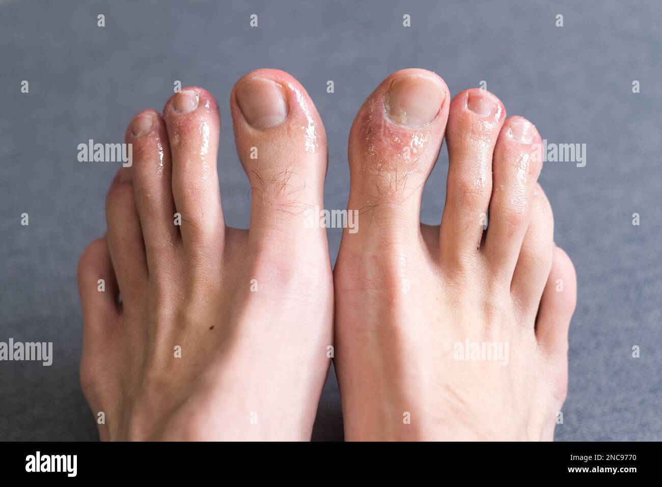 covid toes, bites on a man's toes Stock Photo - Alamy
