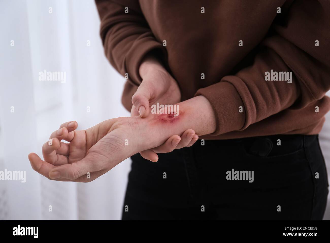 Woman with burn on her forearm indoors, closeup Stock Photo - Alamy