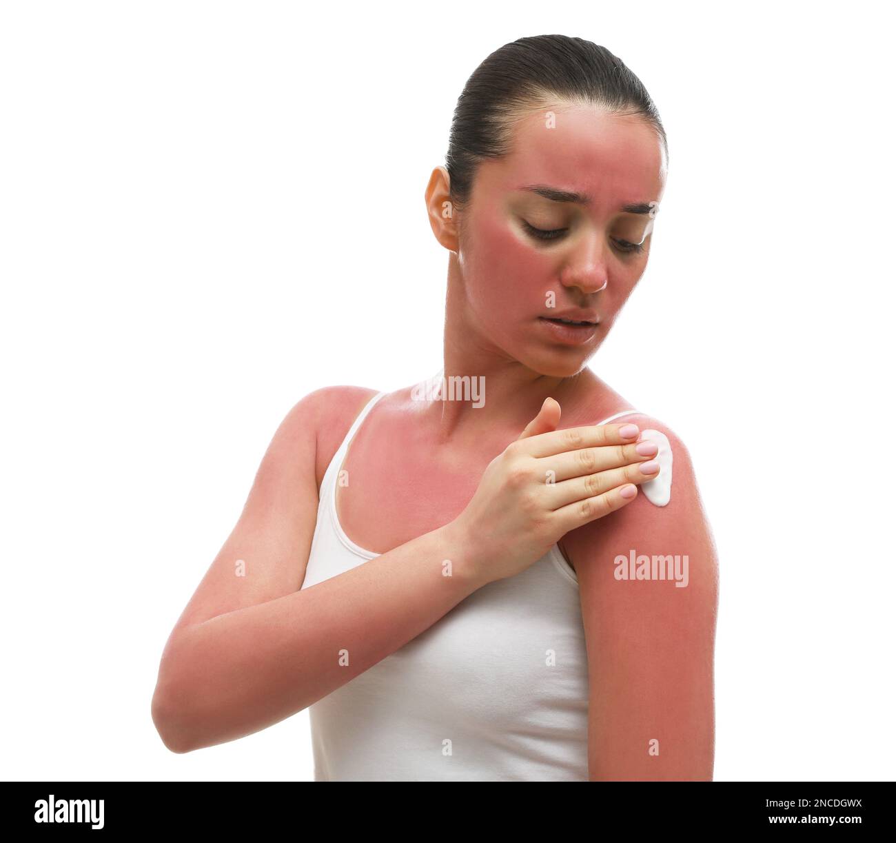 Severe sunburn woman hi-res stock photography and images - Alamy