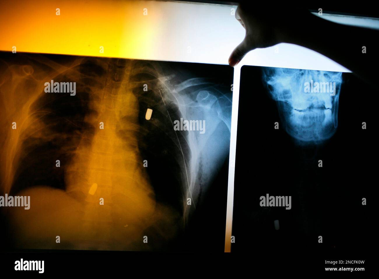 In this photo taken May 14, 2010, a medical resident analyzes X-rays ...
