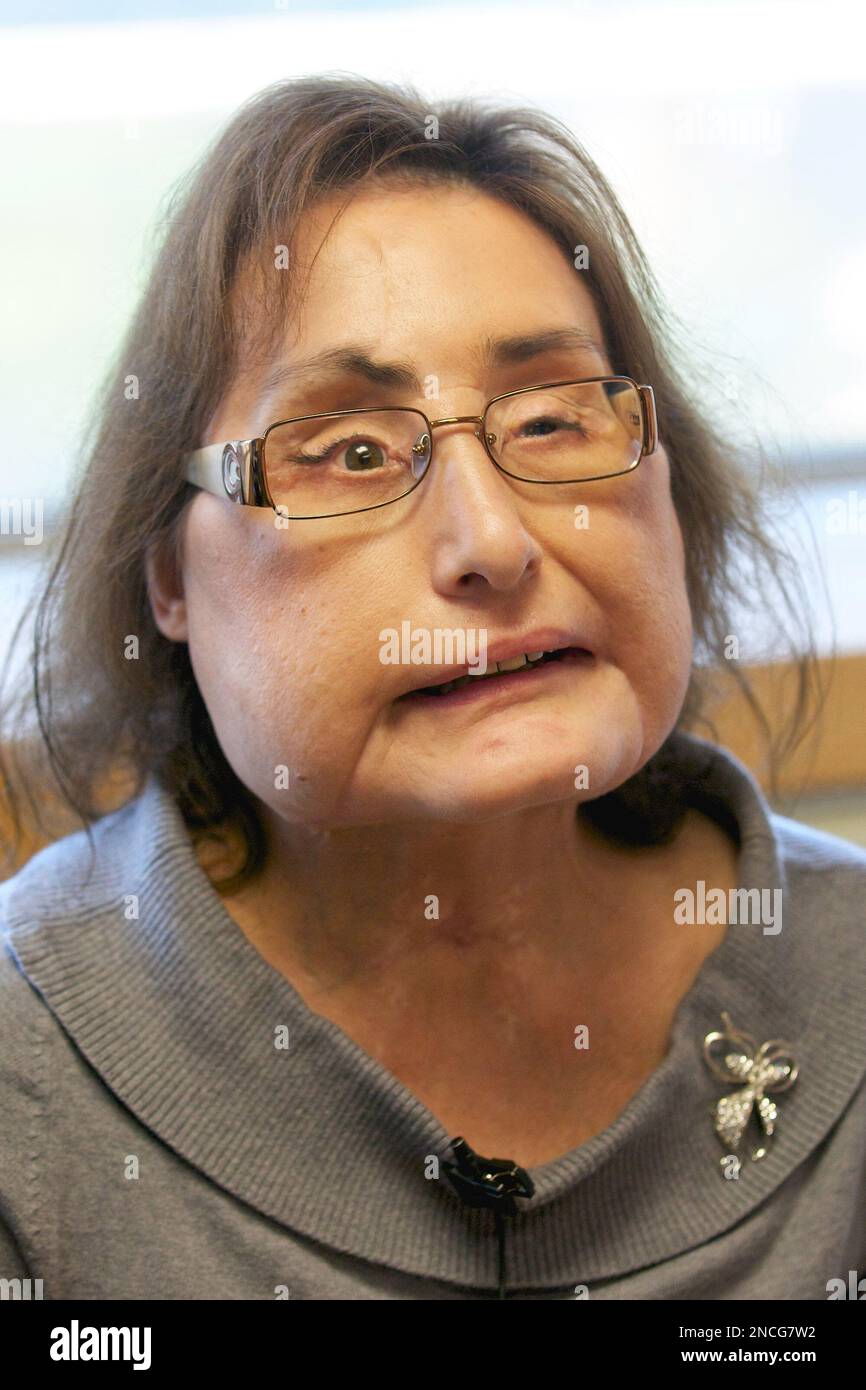 FILE - In this Sept. 14, 2010 file photo, Connie Culp, who underwent ...