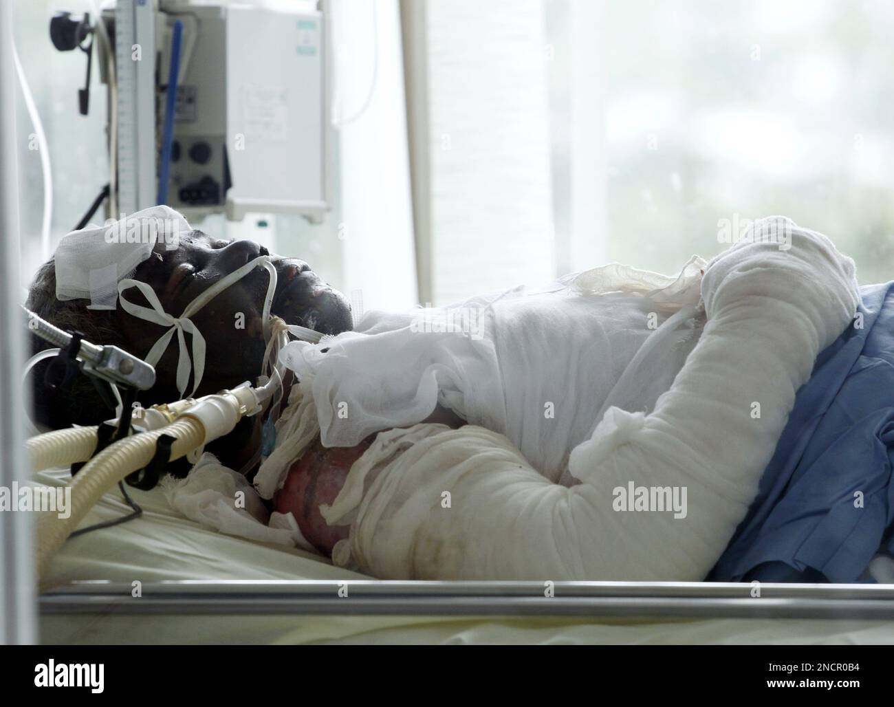 An injured, suffered due to Mount Merapi eruption, lies on a bed at a ...