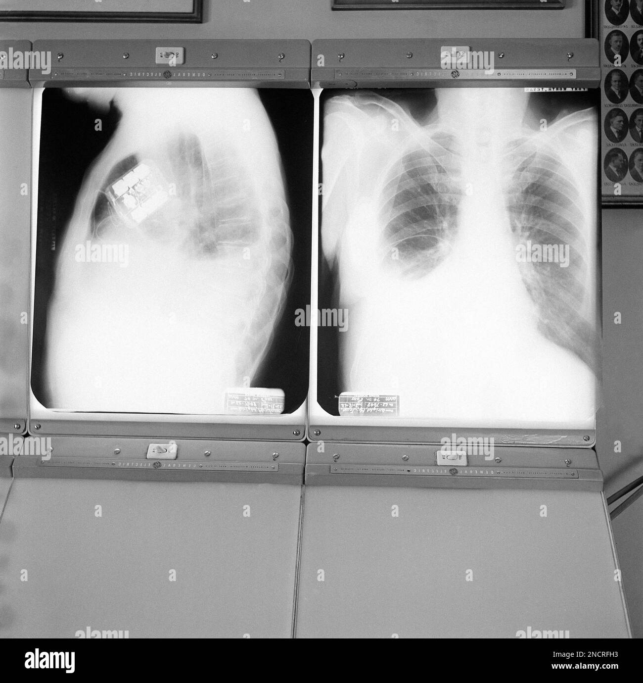 X-ray shows the “life box” in Jesse Wright’s chest in Fort Worth, Texas ...
