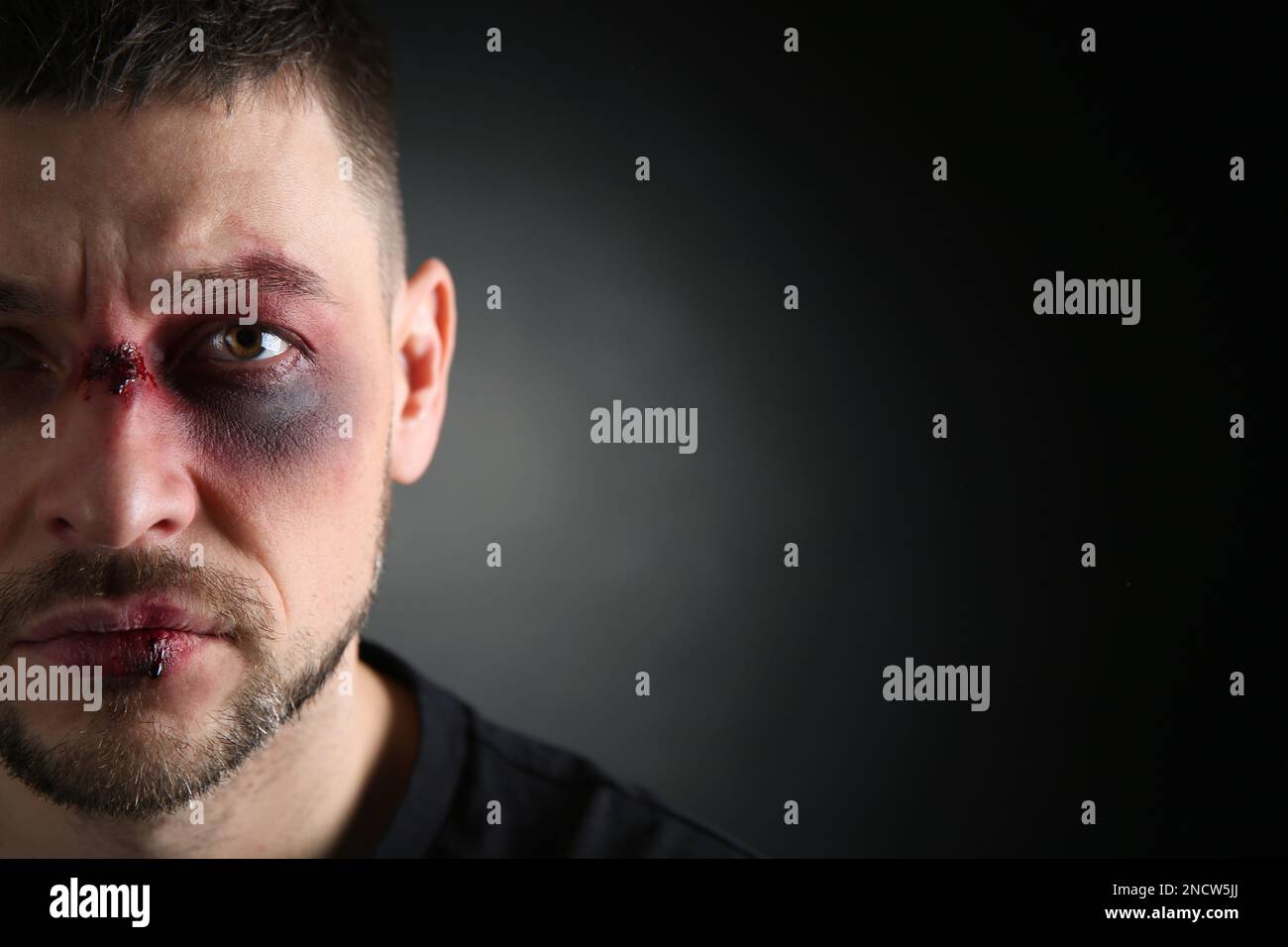 Closeup view of man with facial injuries on dark background, space for ...