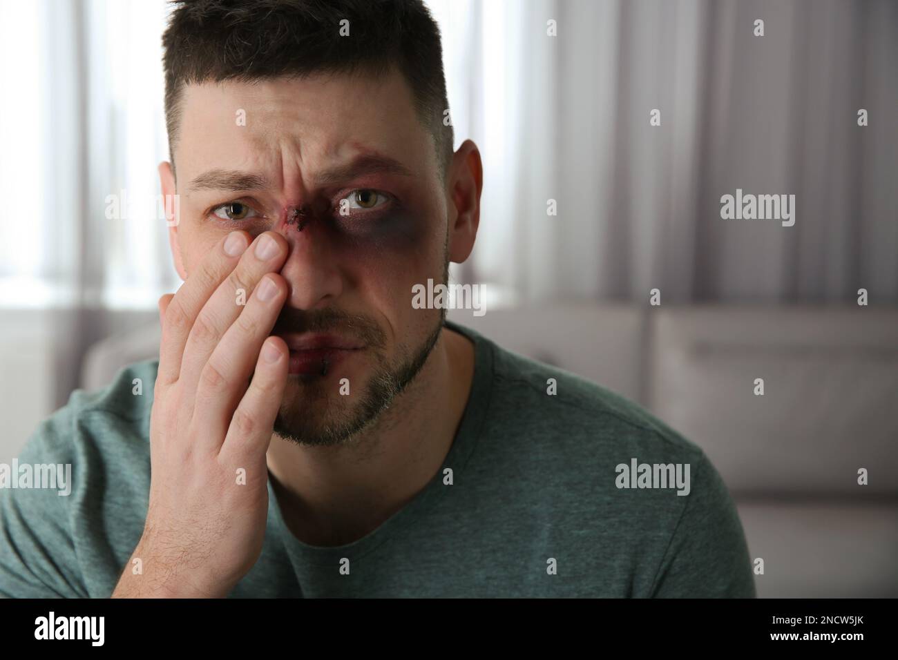 Man with facial injuries at home, space for text. Domestic violence ...