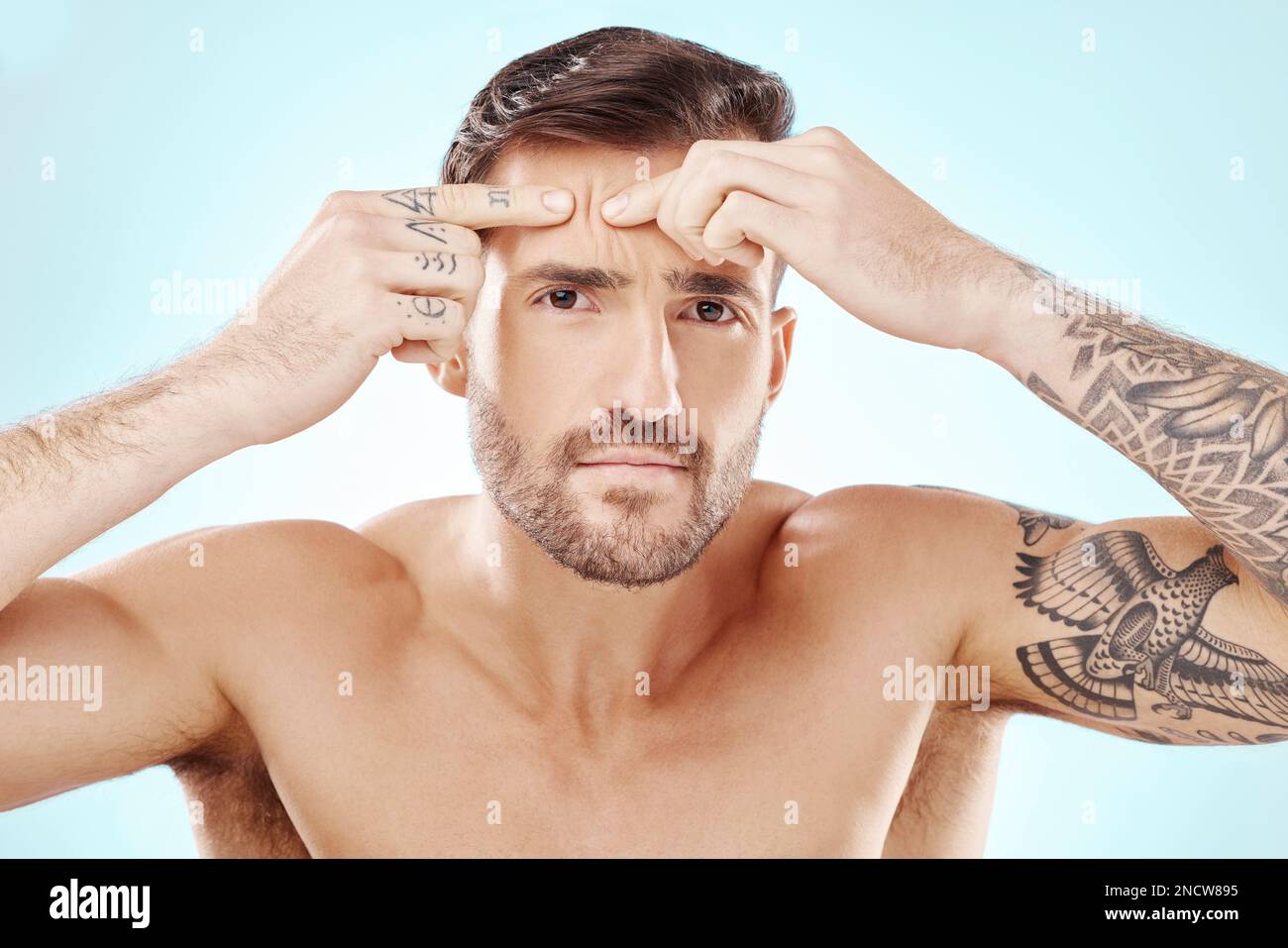 Face, portrait and skin of man with acne or pimple problem with ...