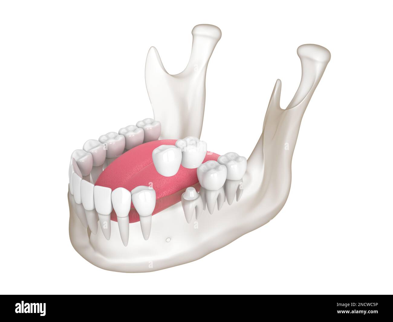 3d render of mandible with dental cantilever bridge over white ...