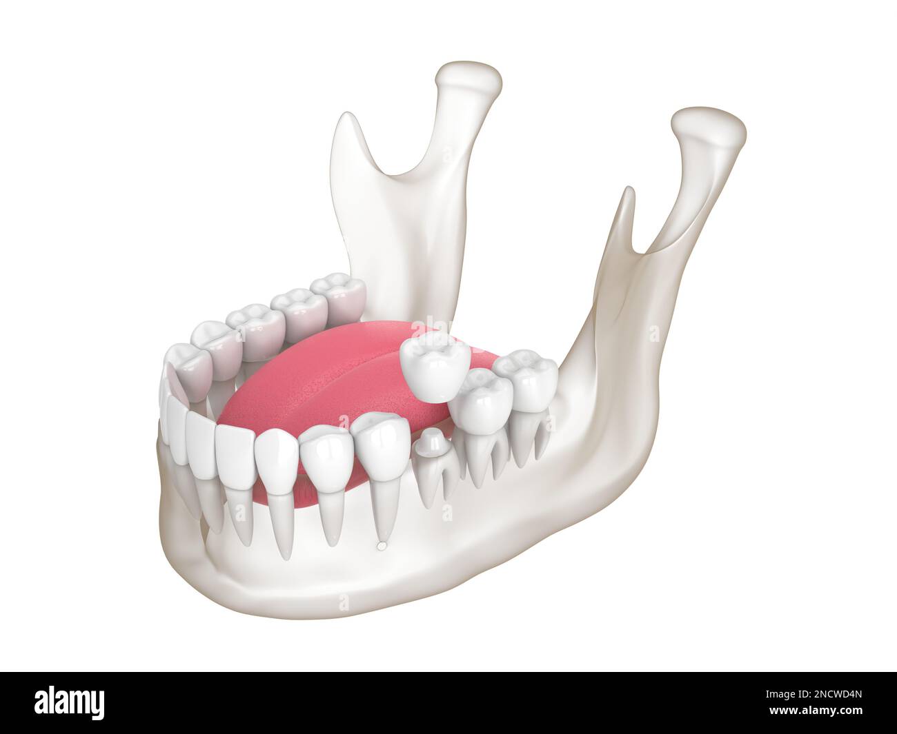3d render of mandible with dental crown embed on reshaped tooth over ...