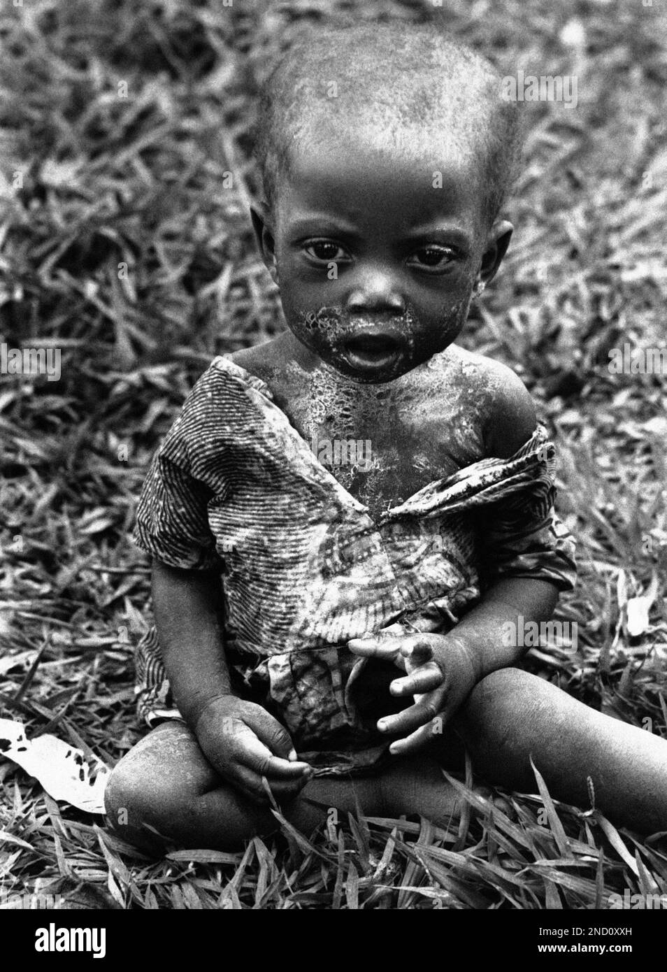 This little Baluba youngster, sick and hungry, at the Miabi Hospital in ...