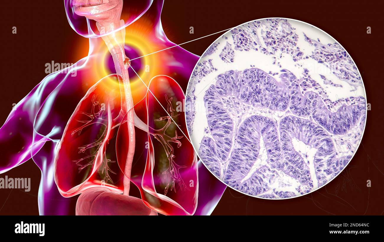 Esophagus gullet oesophagus hi-res stock photography and images - Alamy