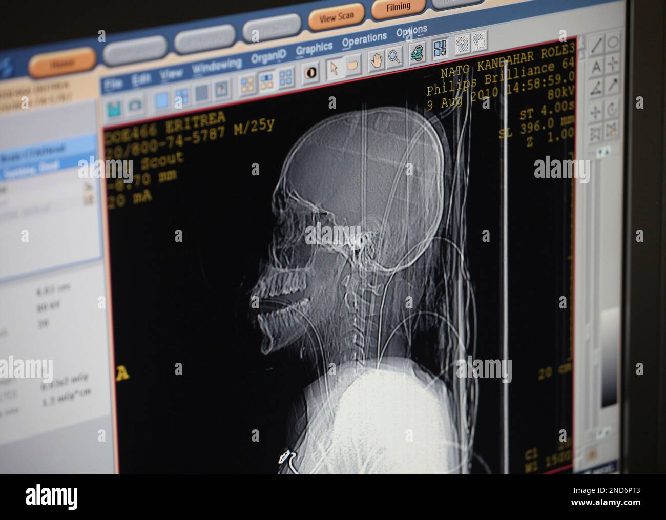 In this Aug. 9, 2010 photo, an Afghan Army soldier wounded in combat in ...