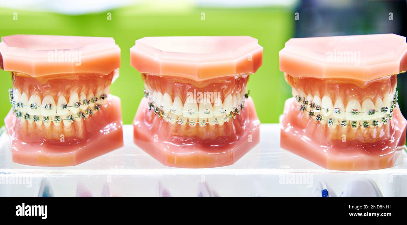 Dental model of the human jaws with teeth and braces Stock Photo - Alamy