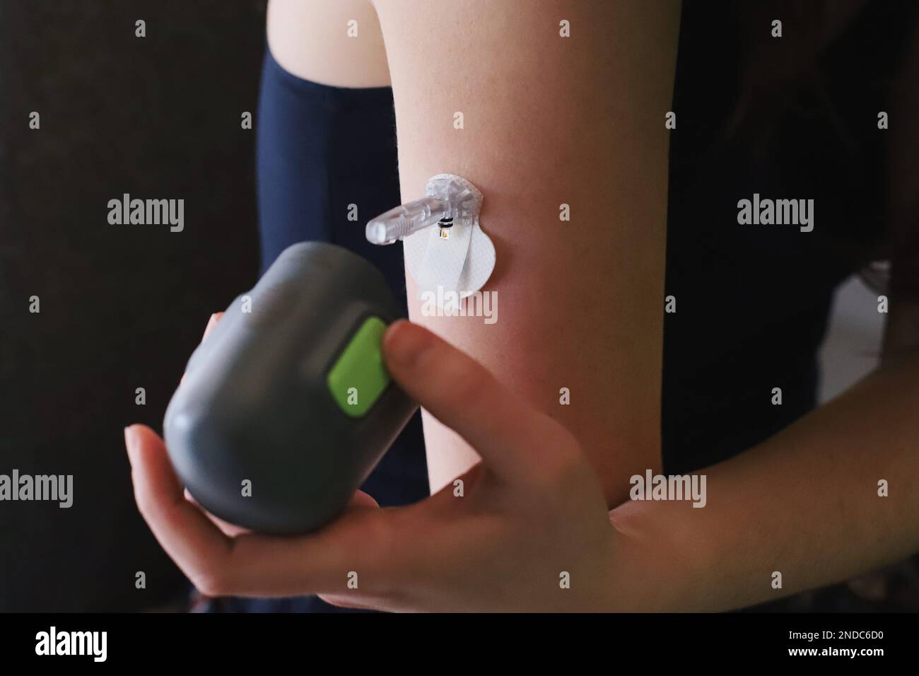 Blood glucose sensor just after insertion with the insertion device ...