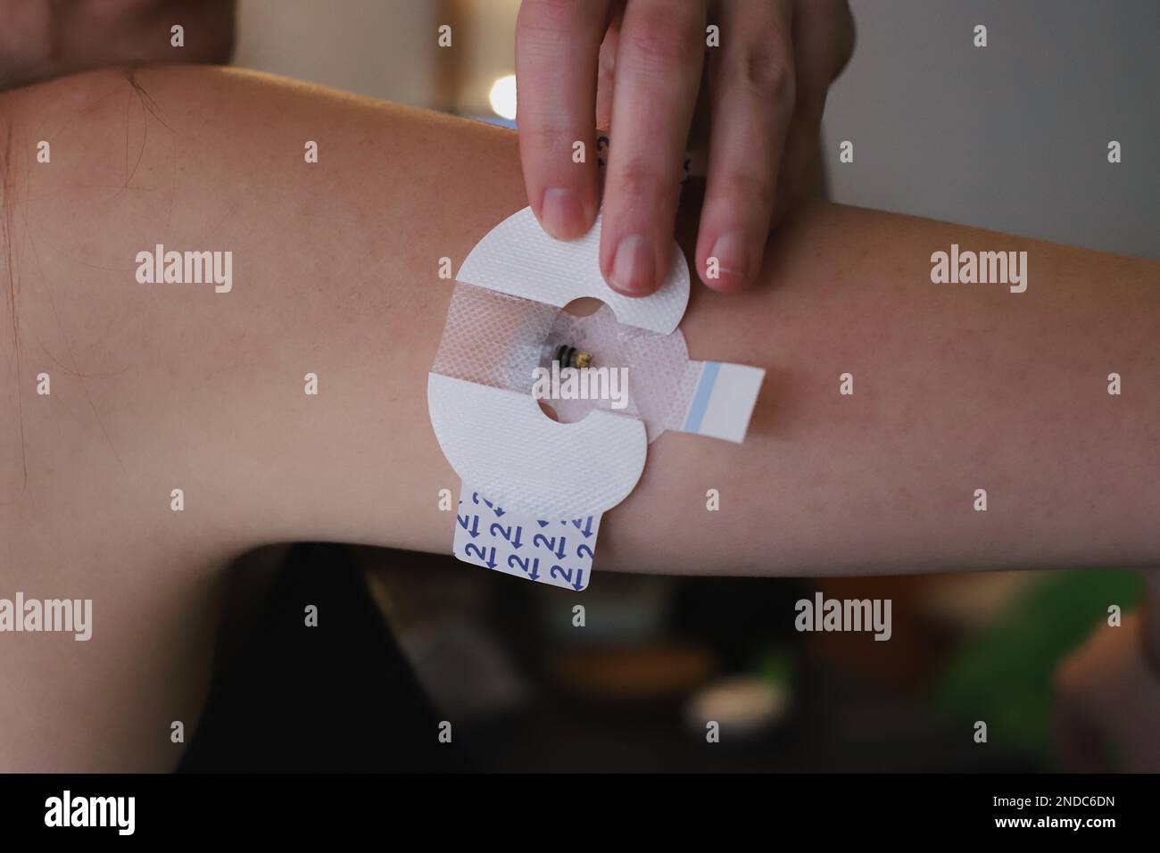Applying the sticker for the blood glucose sensor Stock Photo - Alamy