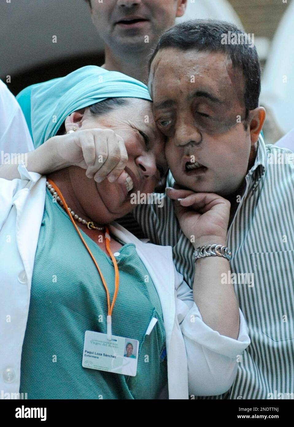 Rafael, a man who underwent a partial face transplant in January ...
