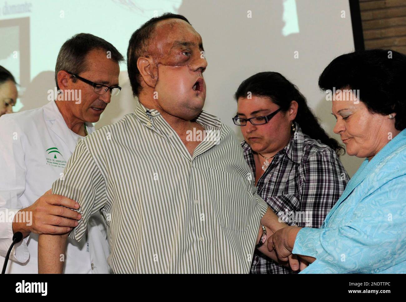 Rafael, a man who underwent partial face transplant in January, appears ...