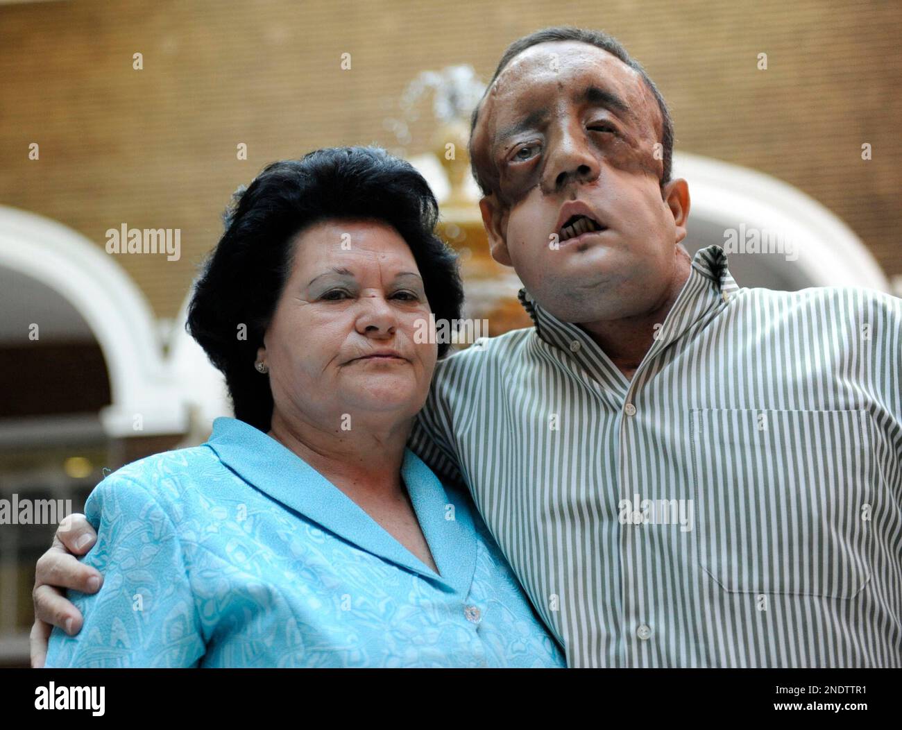 Rafael, a man who underwent partial face transplant in January, pose ...