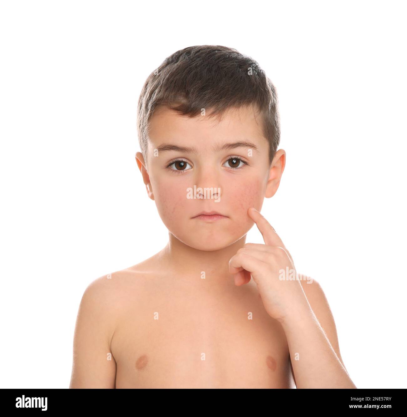 Cute little boy with allergy symptoms on cheeks against white ...