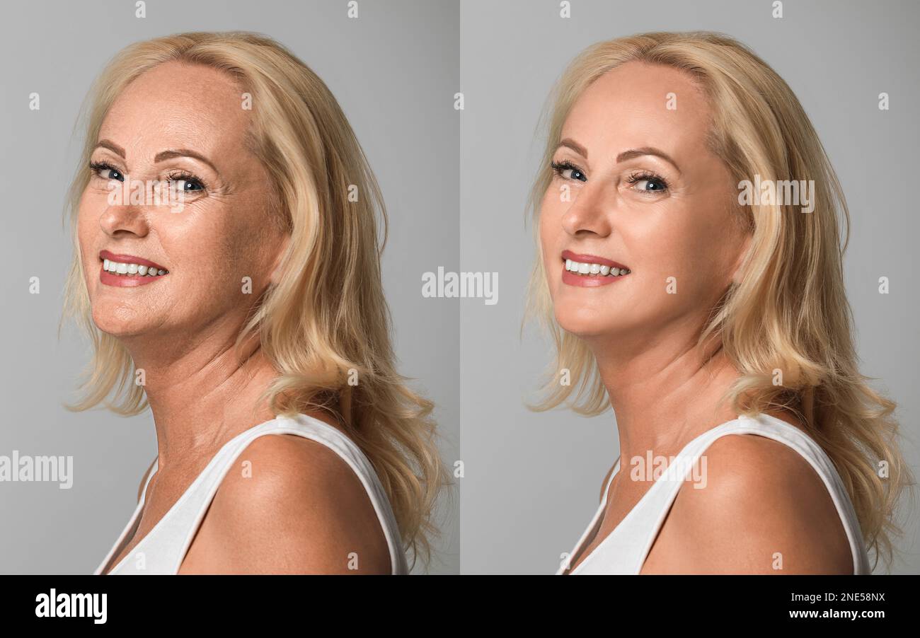 Beautiful mature woman before and after cosmetic procedure on light ...
