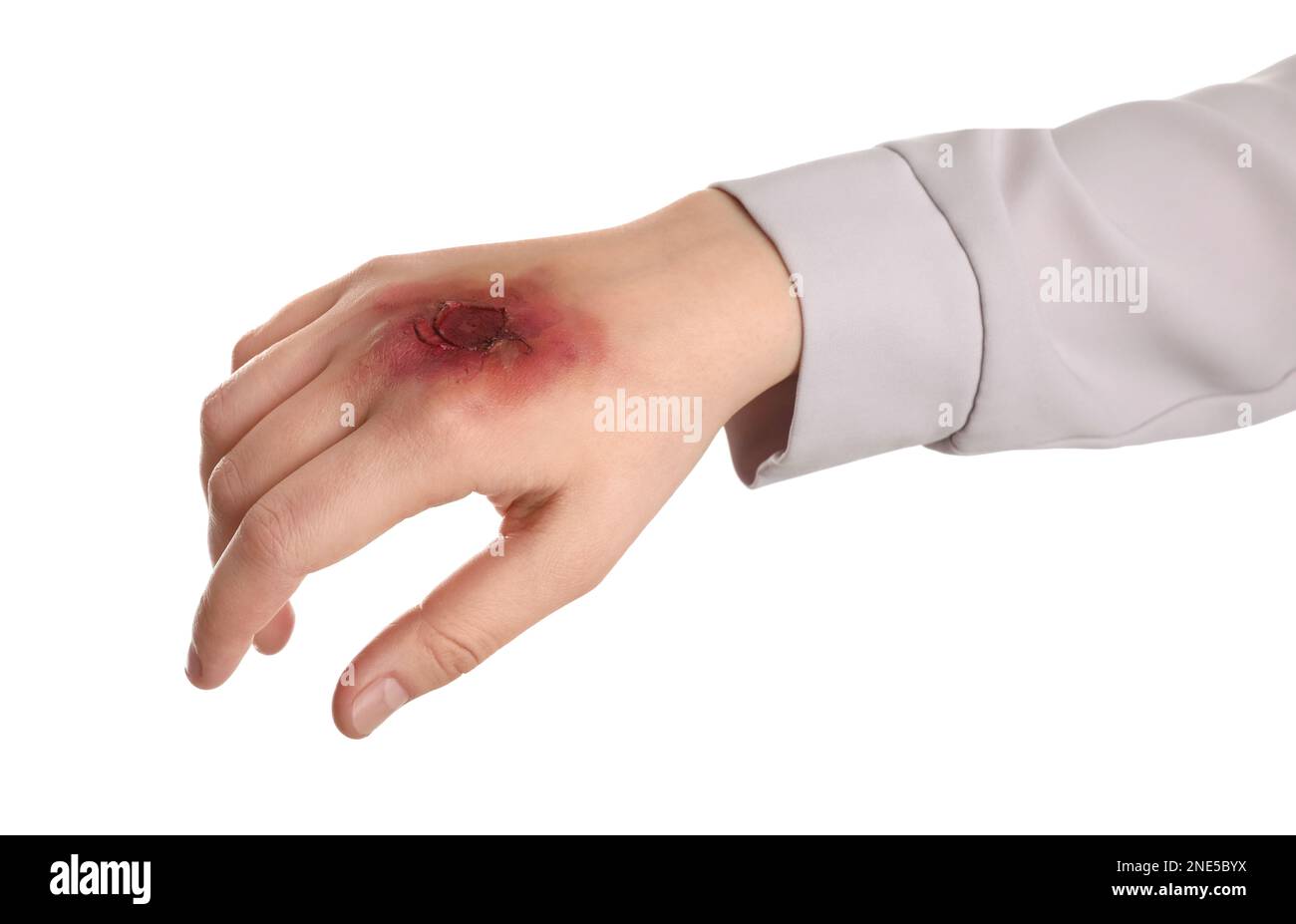 Hand burn scar Cut Out Stock Images & Pictures - Alamy
