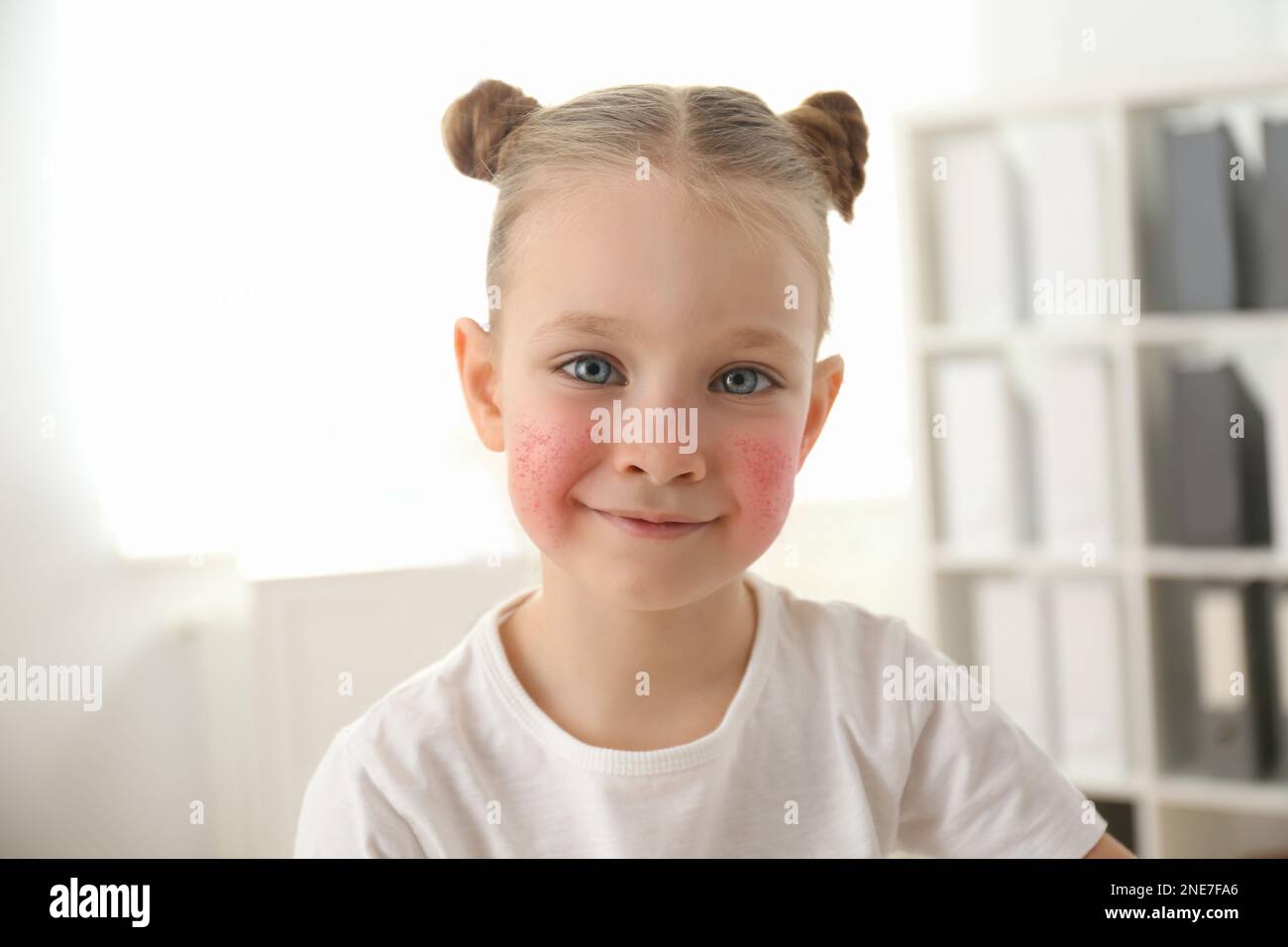 Cute little girl with allergy symptoms on cheeks at home Stock Photo ...