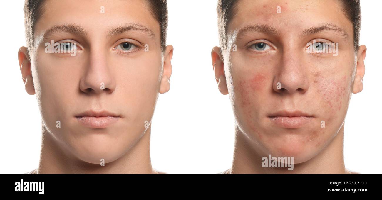 Collage with photos of teen guy with acne problem before and after ...