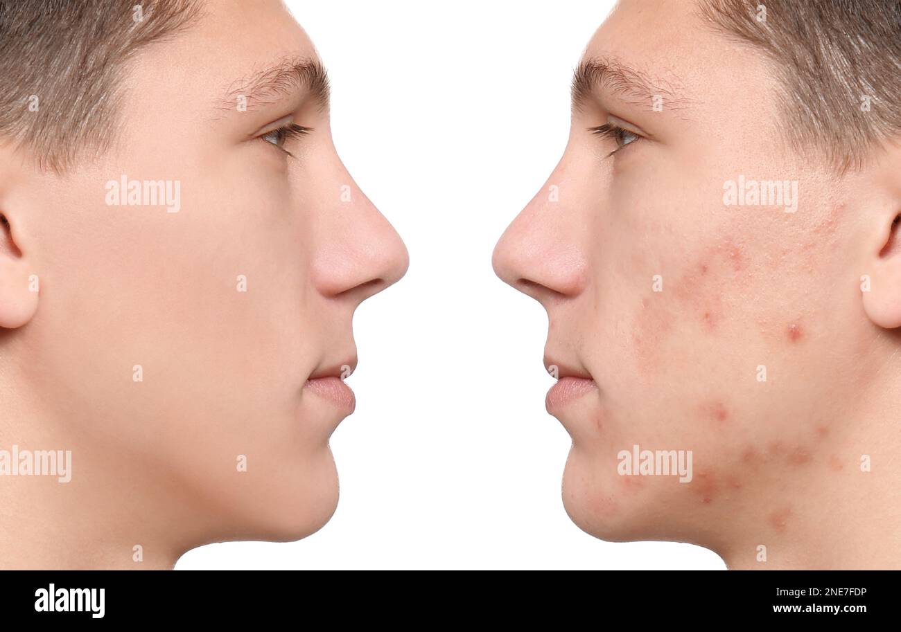Collage with photos of teen guy with acne problem before and after ...