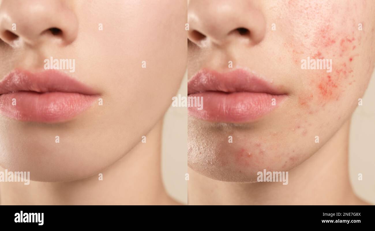 Collage with photos of teenage girl with acne problem before and after ...
