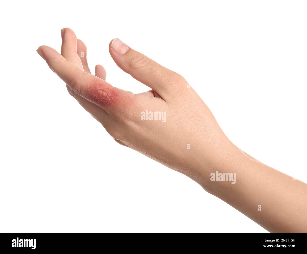 Burn scar hand hi-res stock photography and images - Alamy