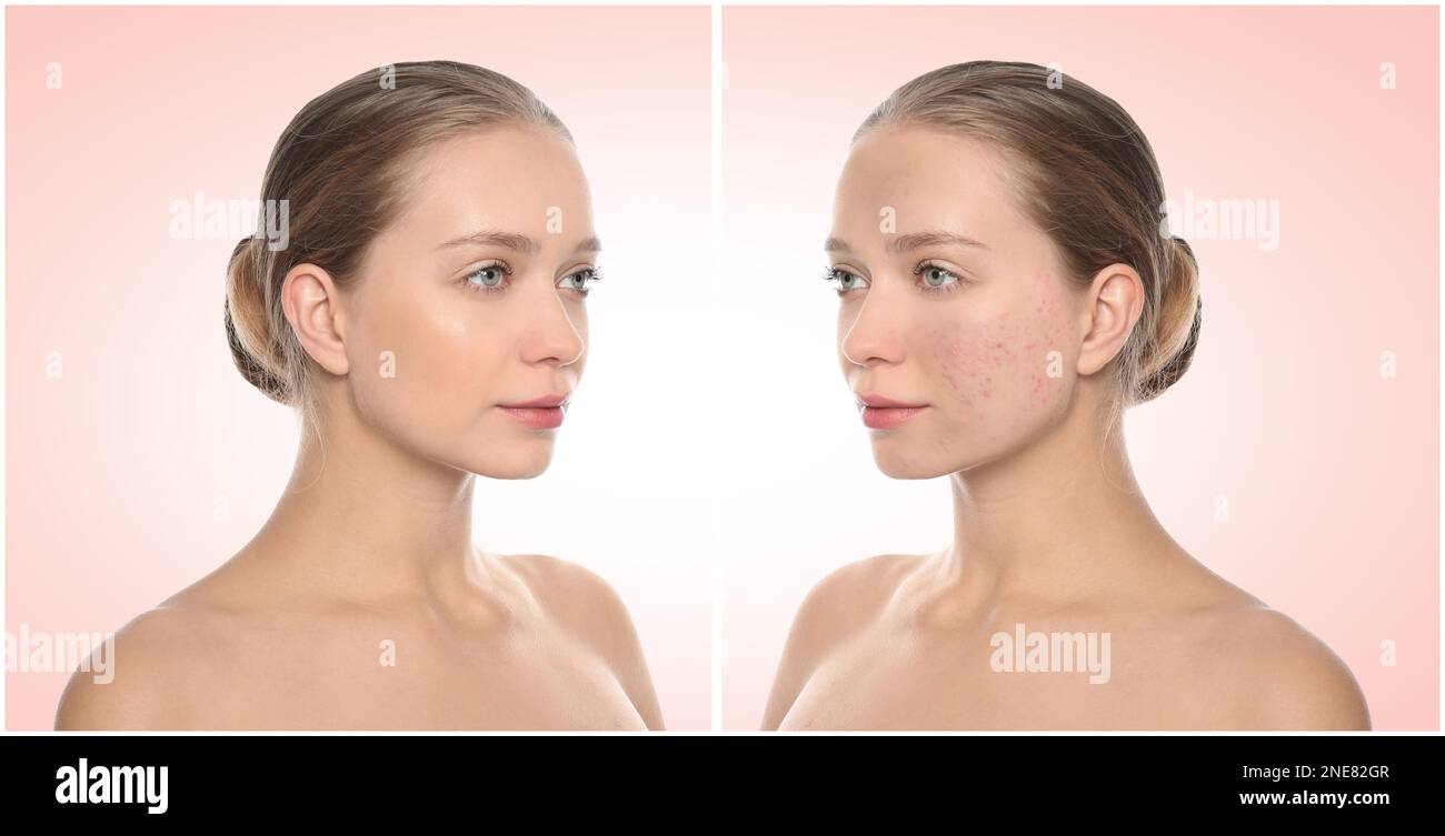 Young woman with acne problem before and after treatment on light ...