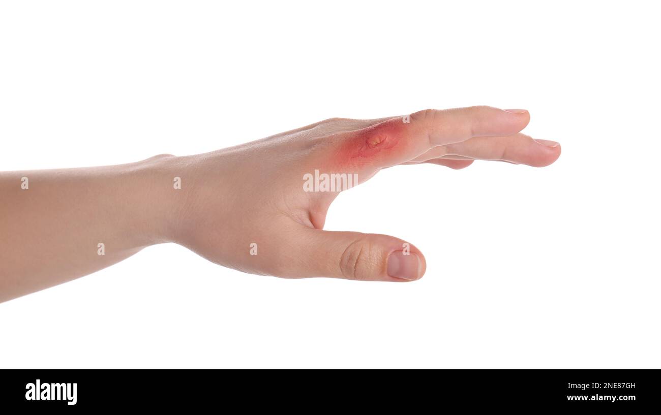 Burn scar hand hi-res stock photography and images - Alamy