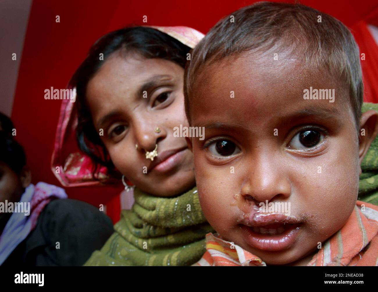 Cleft Lip Before And After Indian