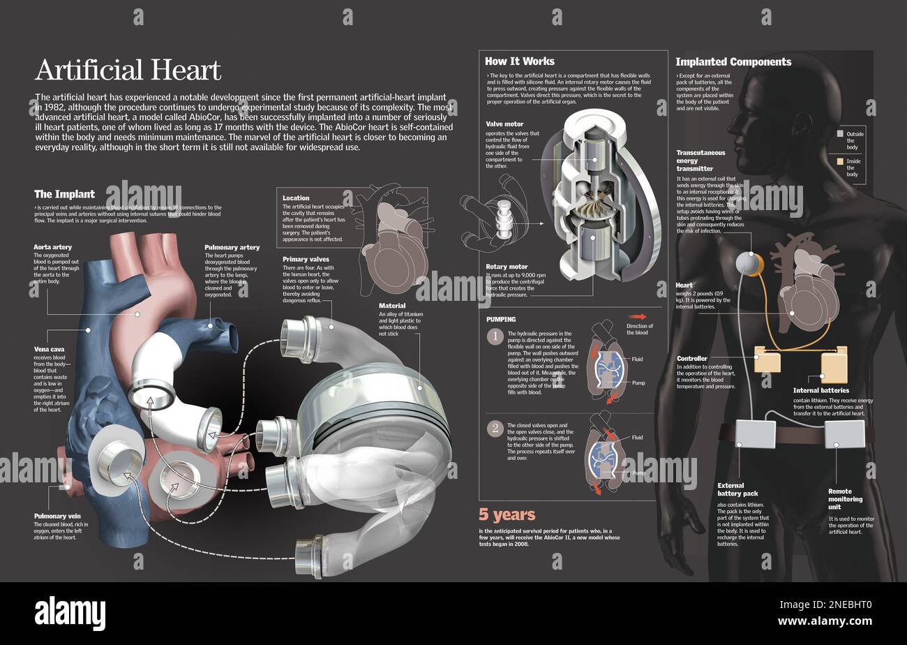 Infographic about the operation and implantation of an artificial heart. [QuarkXPress (.qxp ...