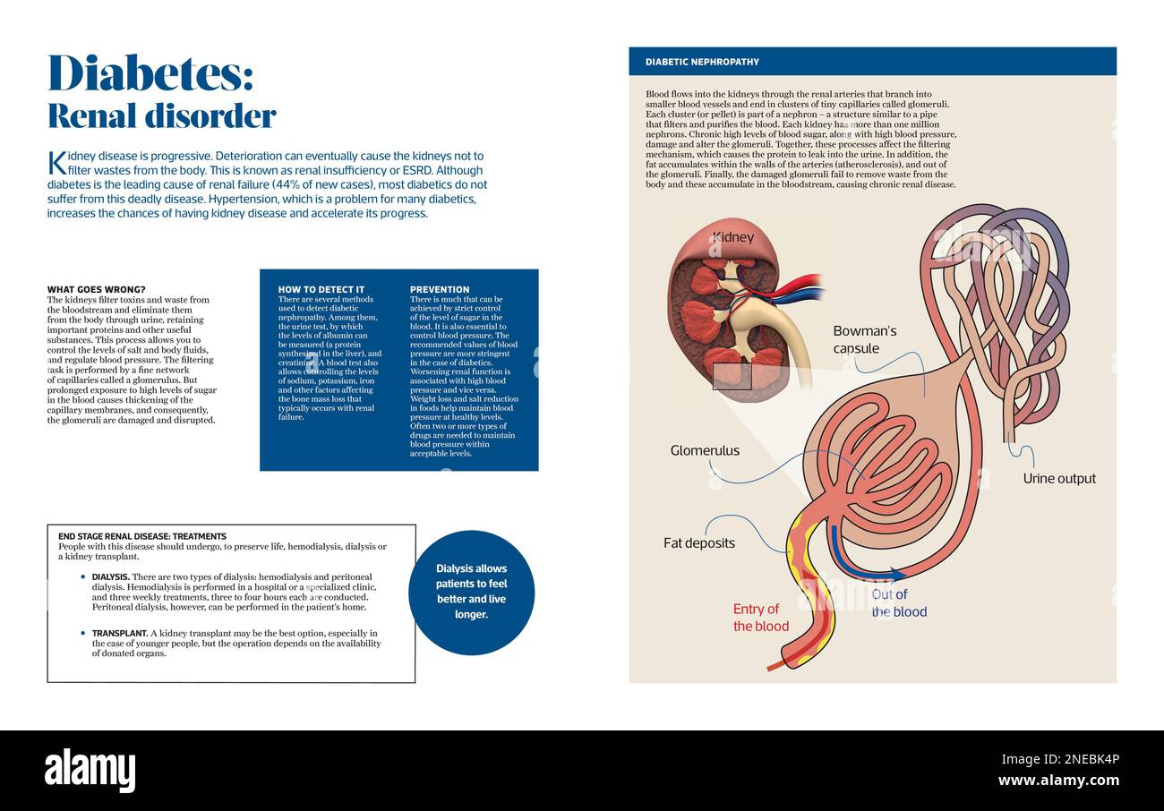 Diabetic Nephropathy It's True! Diabetic Nephropathy Can Lead To